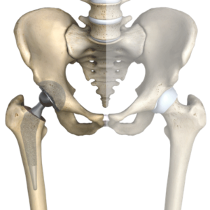Hip Osteoarthritis - An Overview | Dr Chirag Patel