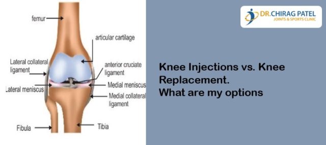Knee Injections vs. Knee Replacement: What Are My Options
