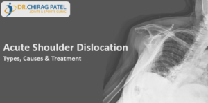 Acute Shoulder Dislocation - Types, Causes & Treatment