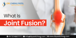 What is Joint Fusion Surgery? | Dr Chirag Patel Orthopedic