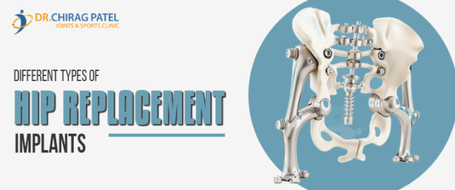 Different Types of Hip Replacement Implants : Benefits